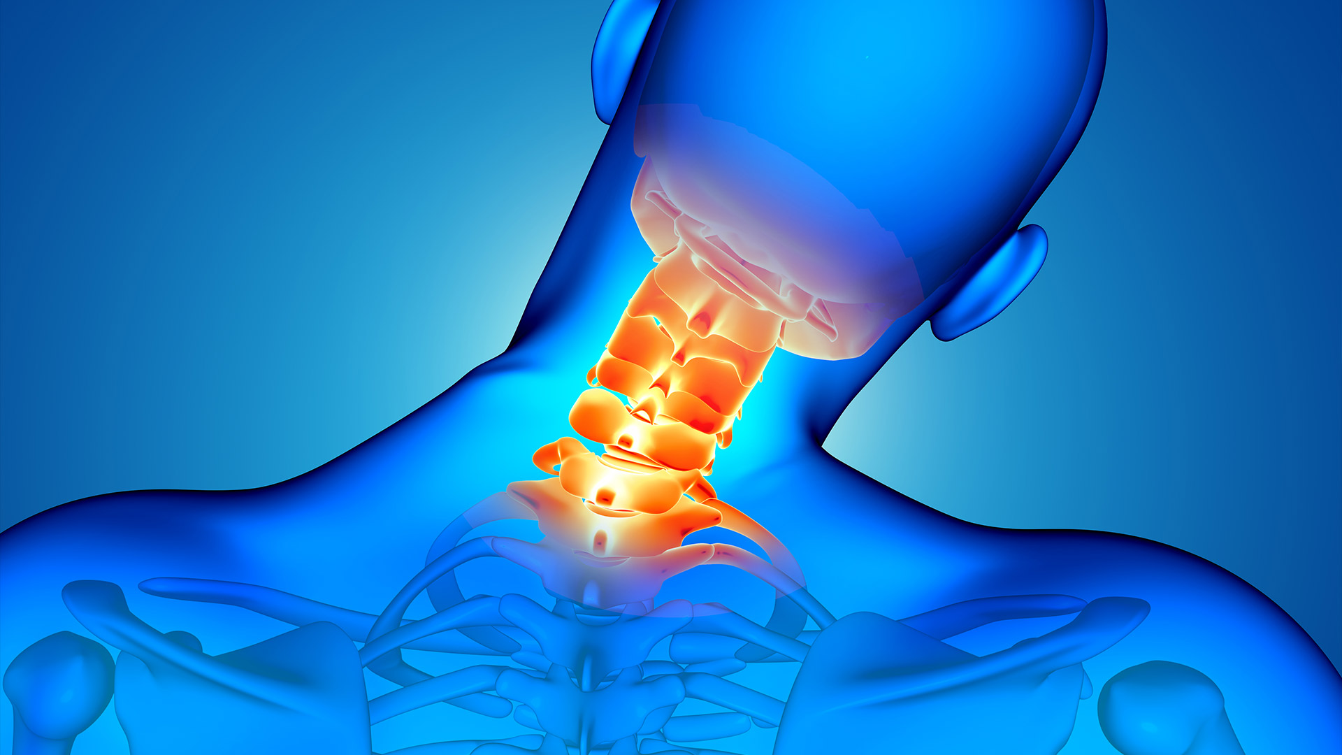 Boyun Düzleşmesi Nedir? - Doç.Dr. Özcan Kaya - 0530 257 73 77
